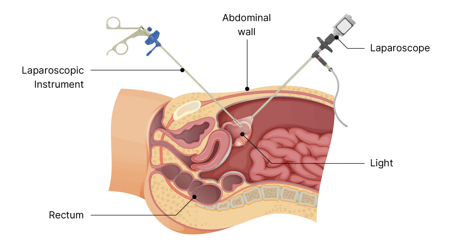 Hernia Repair Keyhole Surgery | Aelius Surgical Centre