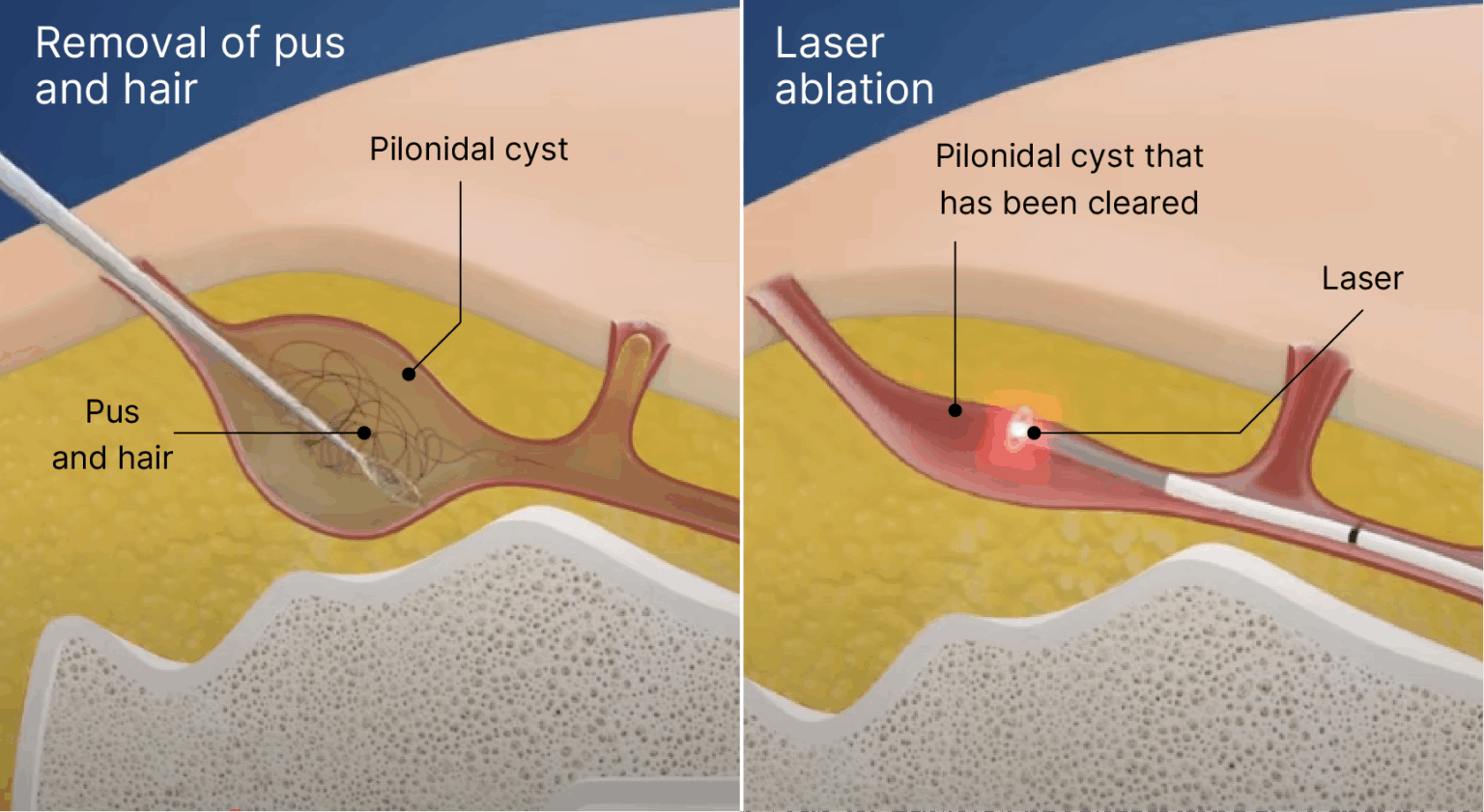 Tailbone Abscess Removal Surgery | Aelius Surgical Centre