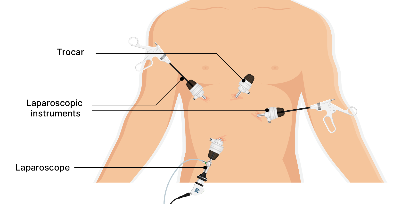 Gallbladder Removal | Aelius Surgical Centre