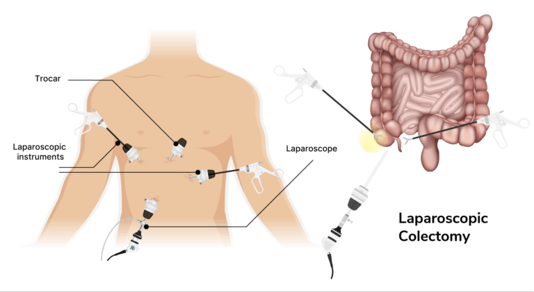Laparoscopic Colectomy | Aelius Surgical Centre