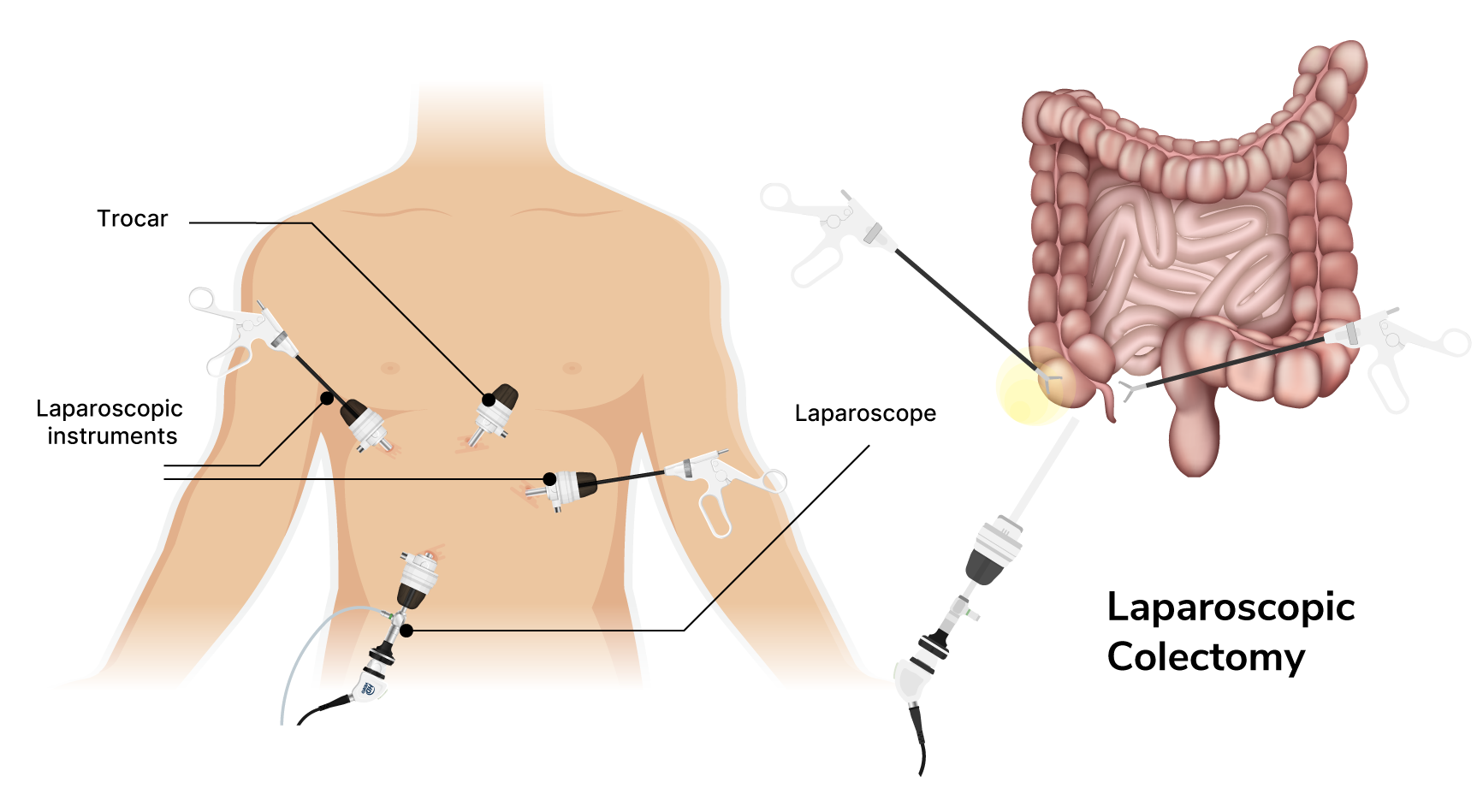 Laparoscopic Colectomy | Aelius Surgical Centre